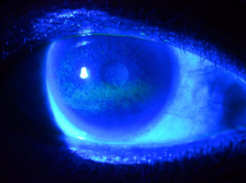 Dry Eye Disease Management | B-Town Eyecare