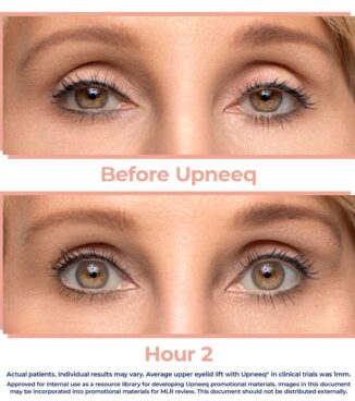 Upneeq Eyelid Drops | B-Town Eyecare